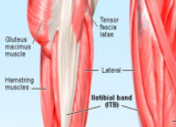 ITBFS (ILIOTIBIAL BAND FRICTION SYNDROME)