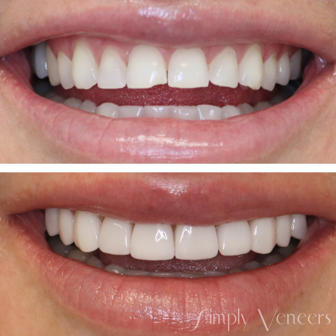 Simply Veneers