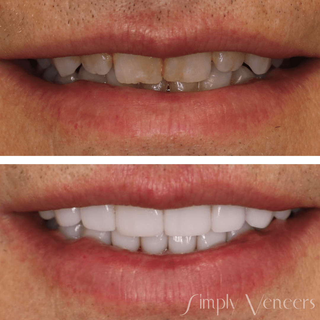 Simply Veneers