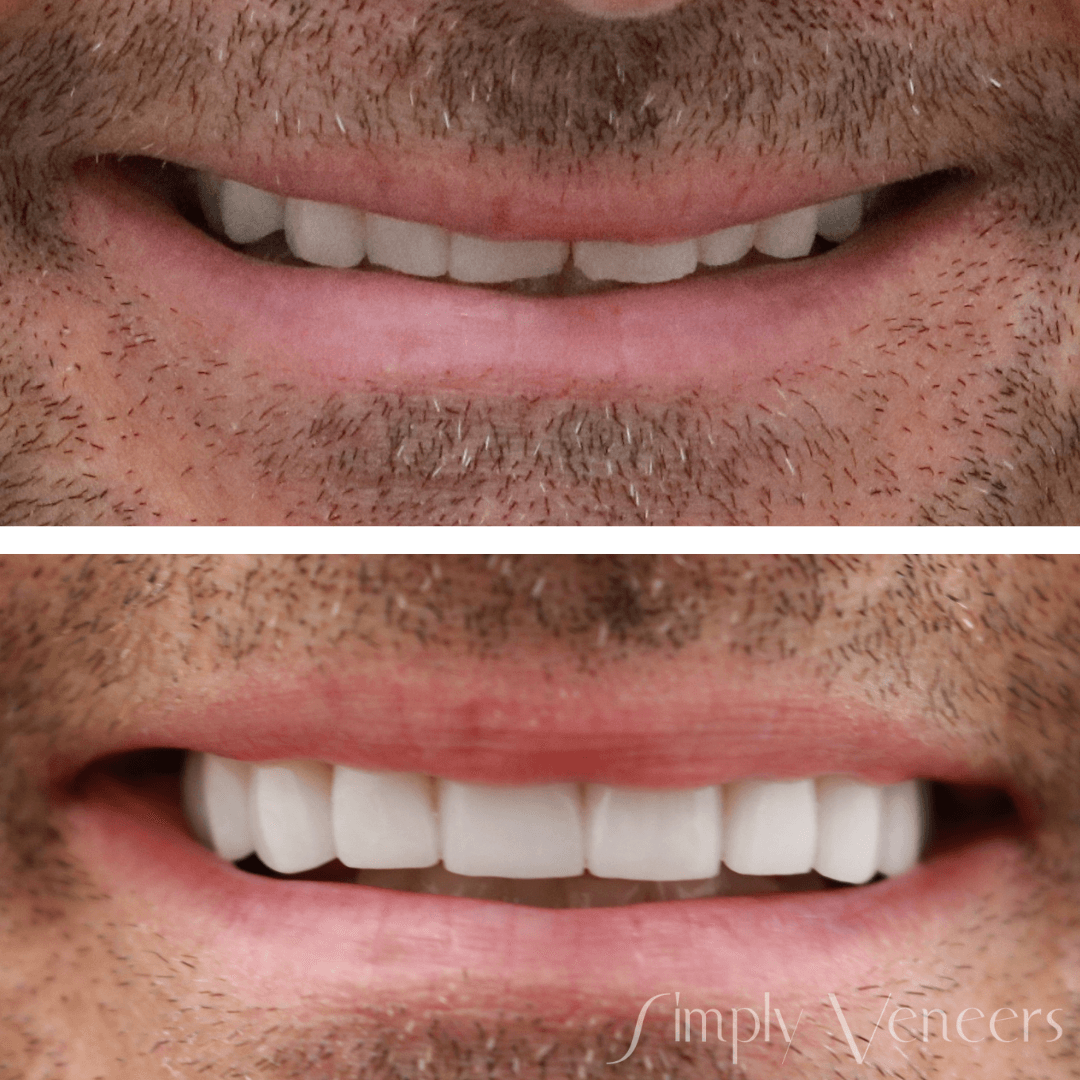 Simply Veneers