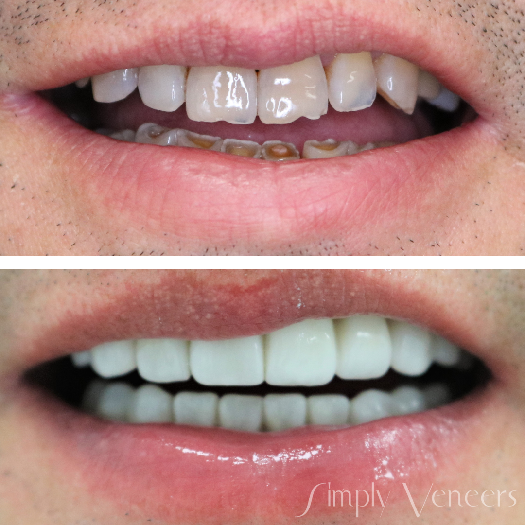 Simply Veneers