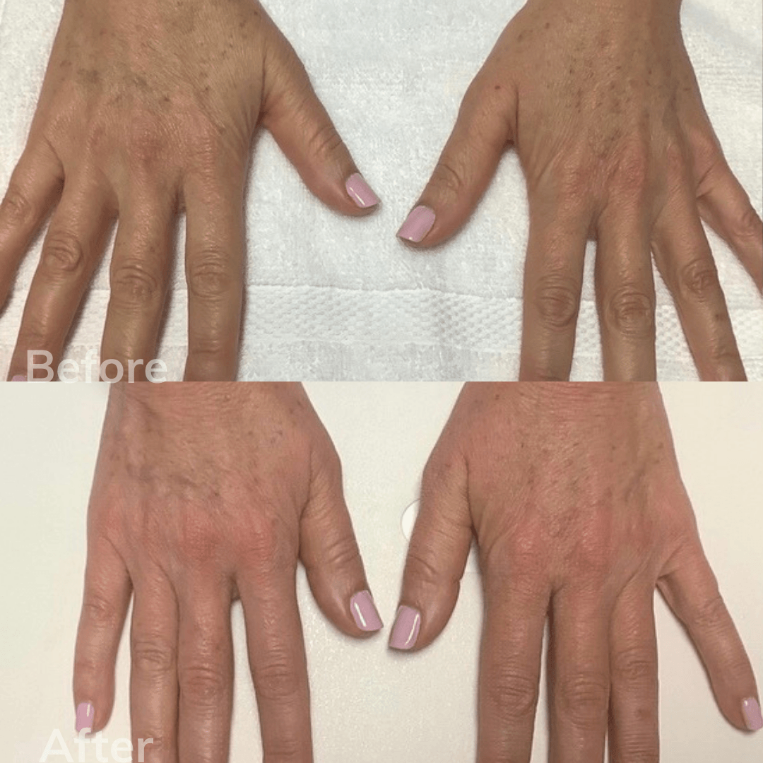 Laser Hand Rejuvenation | The Studio Med Spa San Marcos