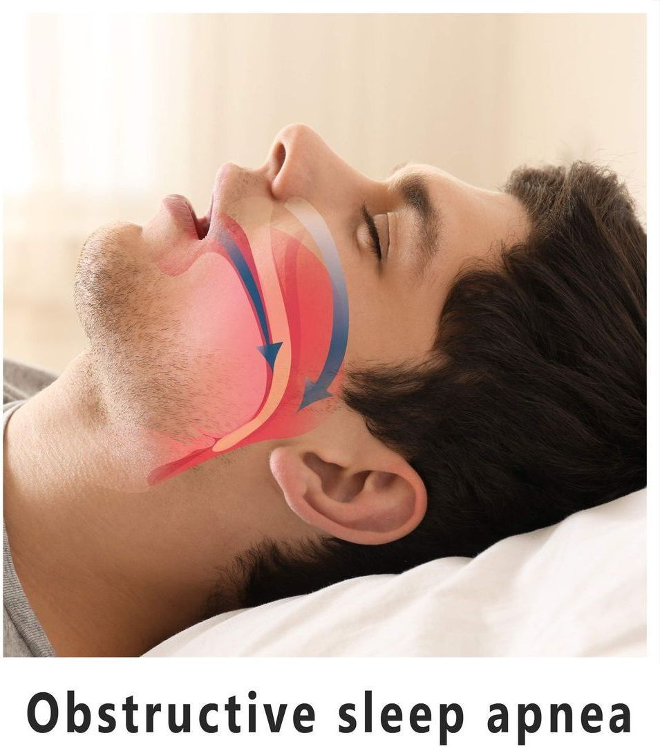 Obstructive Sleep Apnea | Complete Health Dentistry of SoCal
