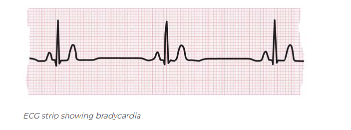Bradycardia Algorithm For ACLS Review