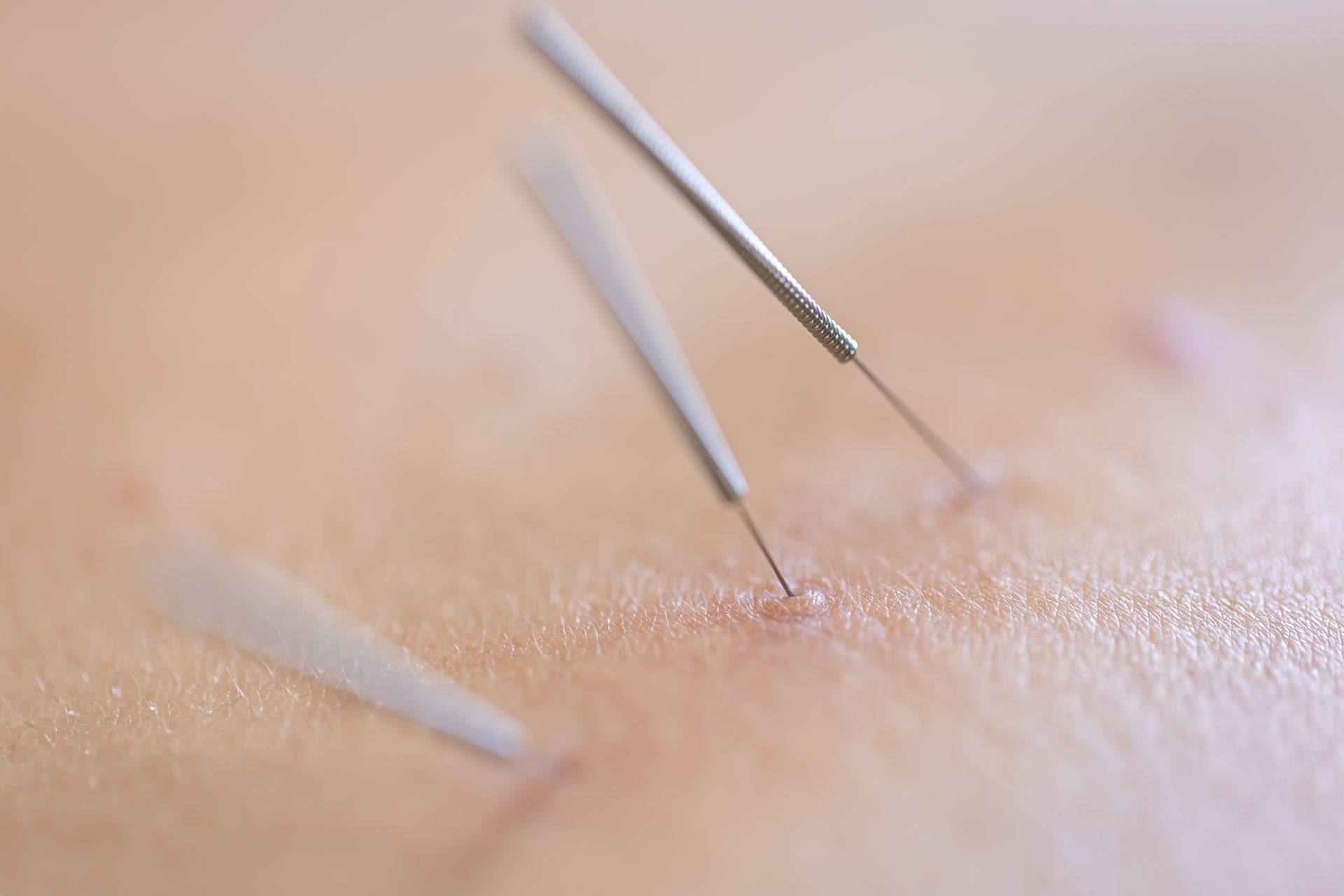 How Dry Needling can Alleviate Muscle Pain and Influence Wellness