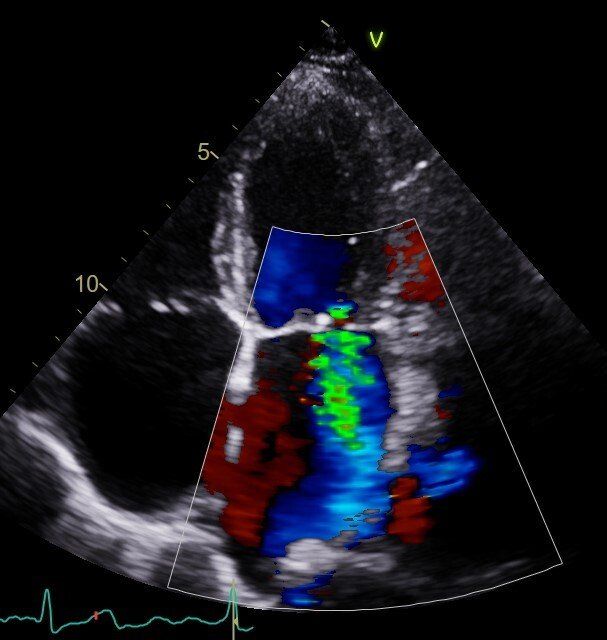 Echocardiogram