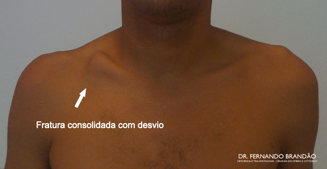 Fratura Da Clavicula Direita Infográfico: 4 Formas De Prevenir A