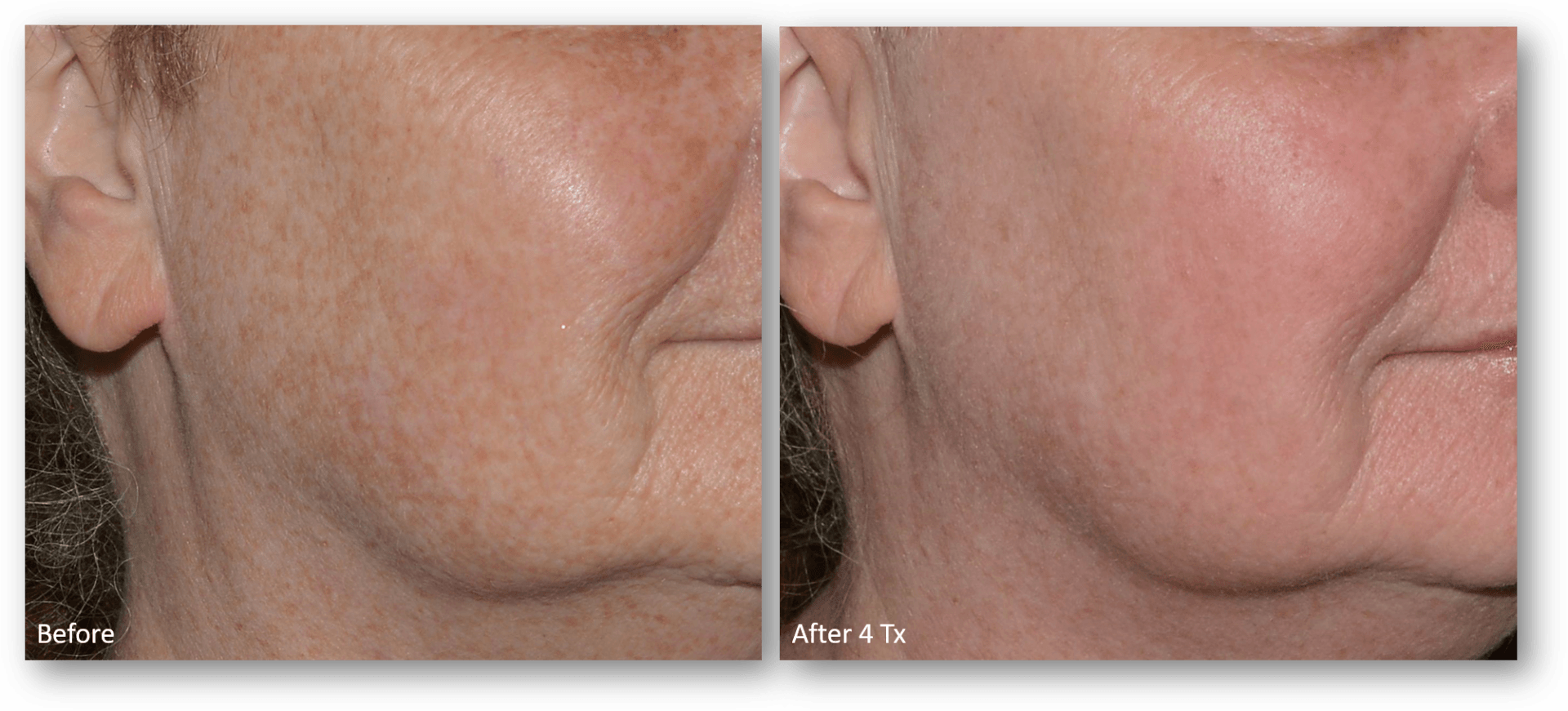 Chicago, IL Laser Resurfacing Services | Dr. Yates Lifestyle Med Spa