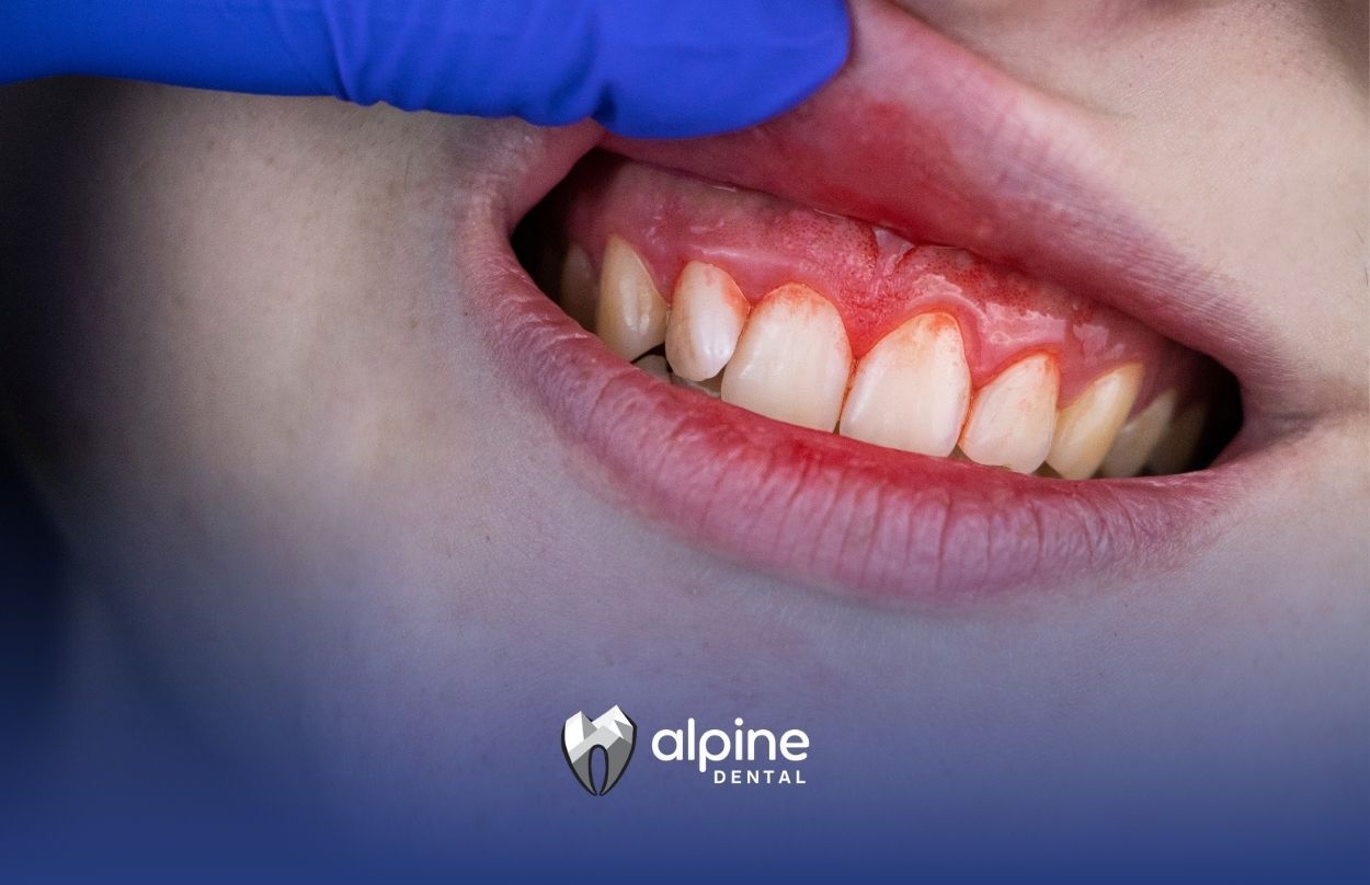Periodontal Disease Explained: Causes, Symptoms, and Solutions | Alpine ...