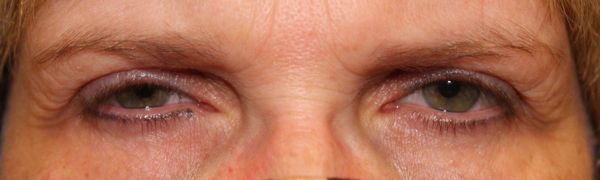 Before and After Gallery | Eyesthetics by T. Amerson Pegram, MD