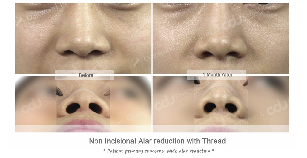 Alar Reduction Surgery in Seoul | Gangnam Plastic Surgery Clinic & Cost