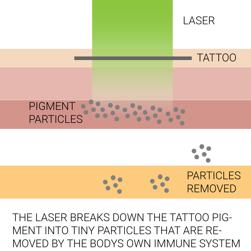 How tattoo removal works - Bronctattooaus.com