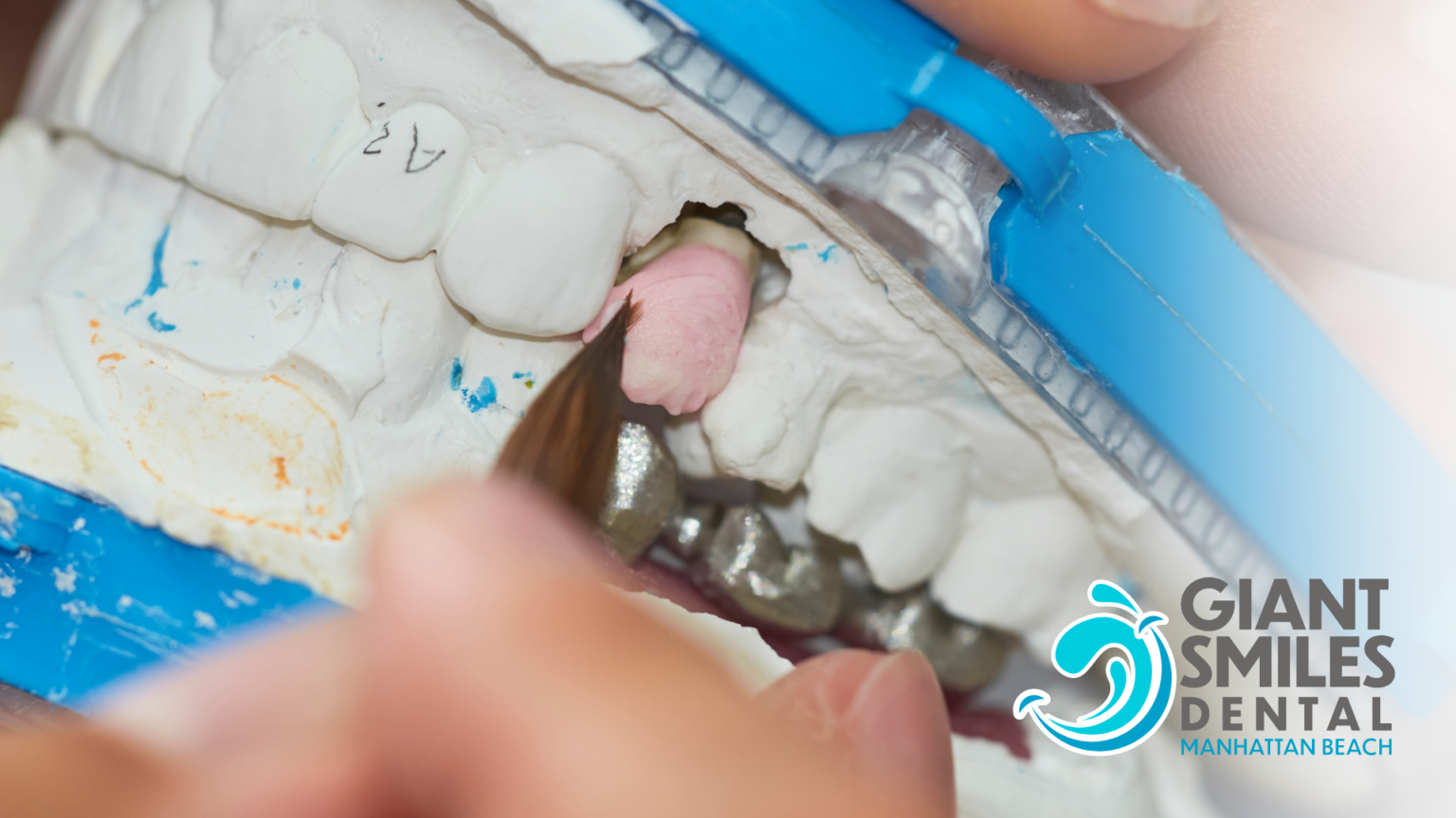 Dental Inlays & Onlays | Giant Smiles Dental