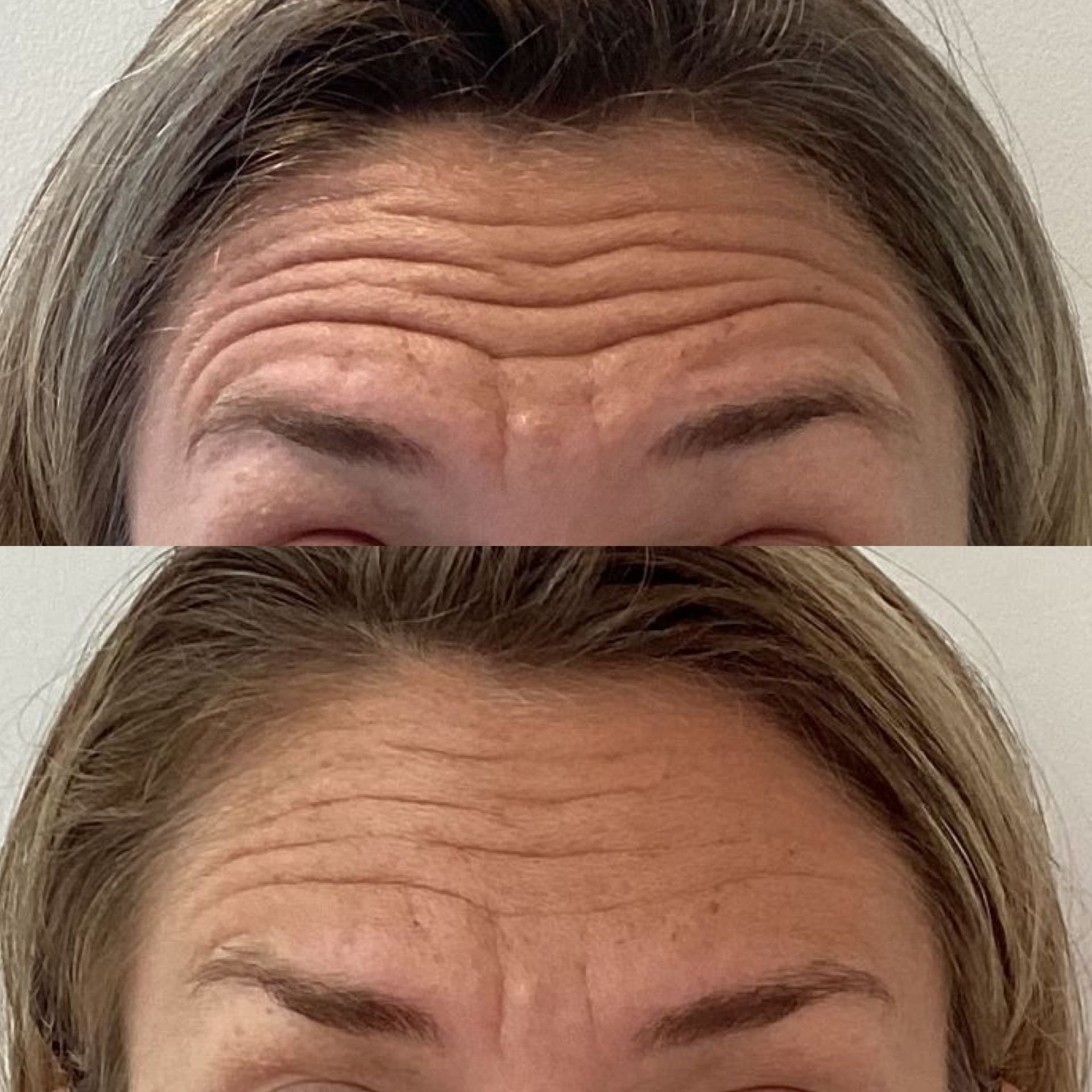 Voorhoofd Behandeling | Cosmopolitan Clinic Amsterdam | Amsterdam