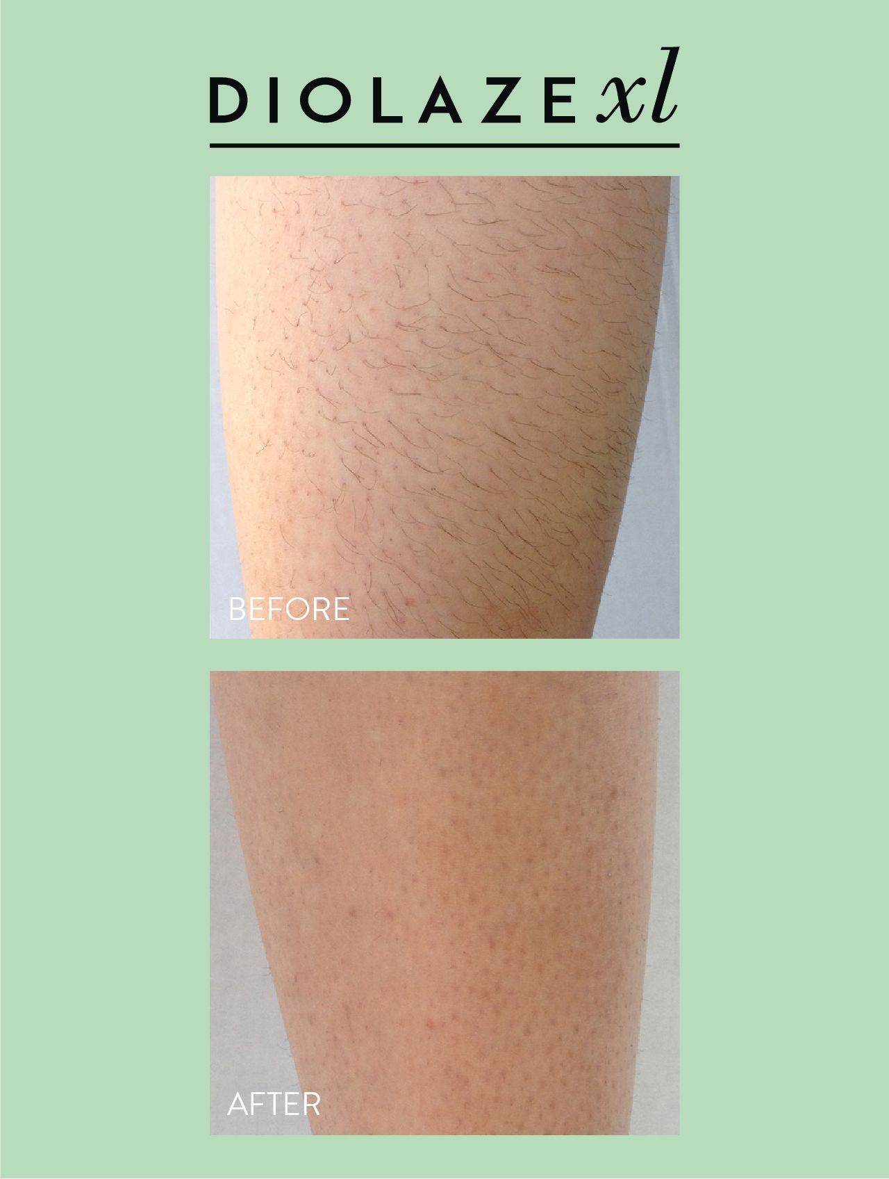 Laser Hair Removal | Wagoner Family | Nacogdoches, TX