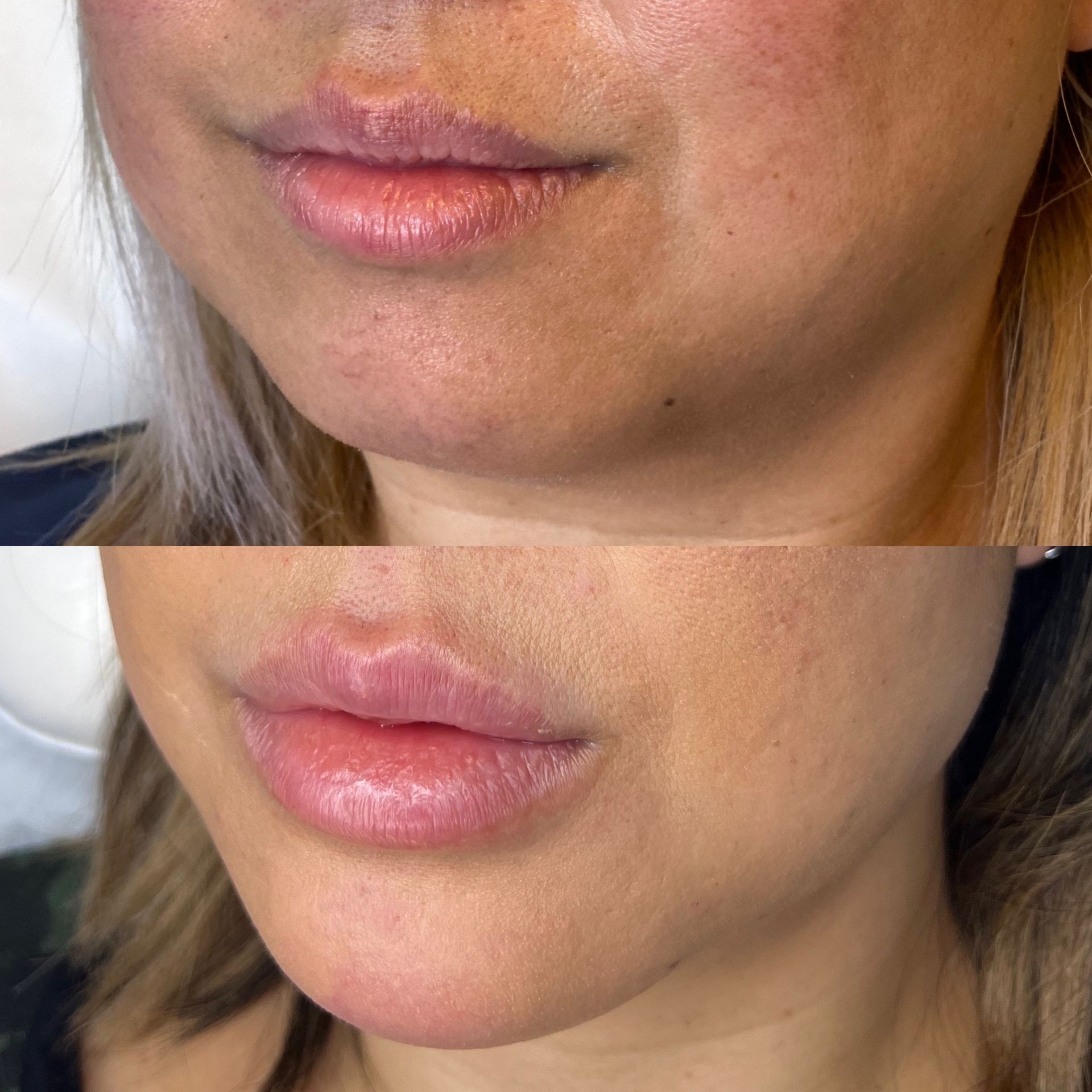 Dermal & HA Fillers in Burlington | Modern You Medical Aesthetics