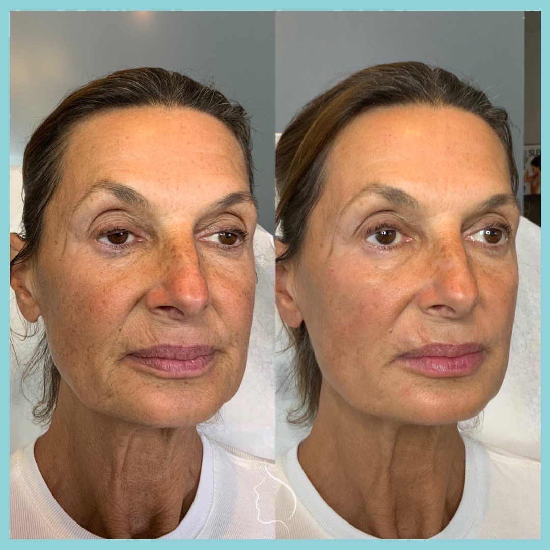 Dermal & HA Fillers in Burlington | Modern You Medical Aesthetics