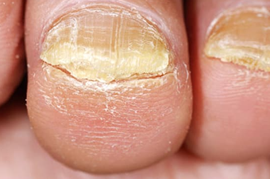 Why Is My Toenail Yellow!? Nail Fungus And What You Need To Know