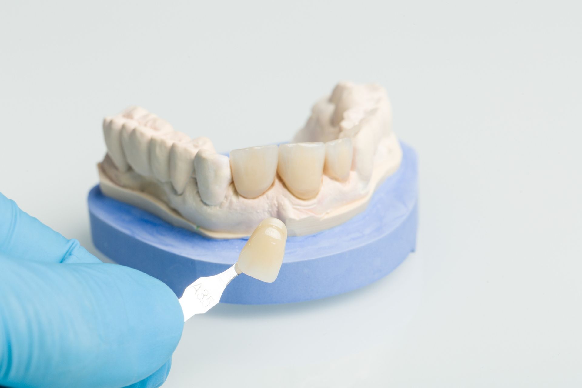 Dental Crowns And Bridges Restoring Function And Aesthetics