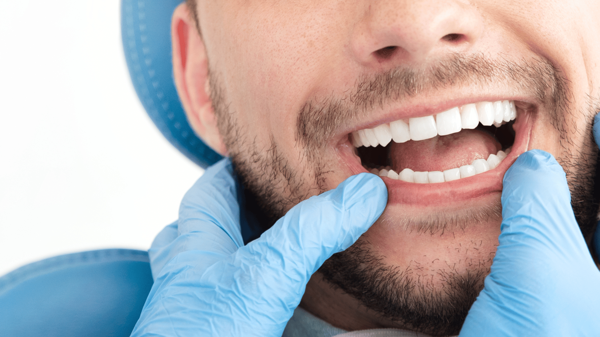 What to Do If You Have a Chipped Tooth? | Duxton Dental