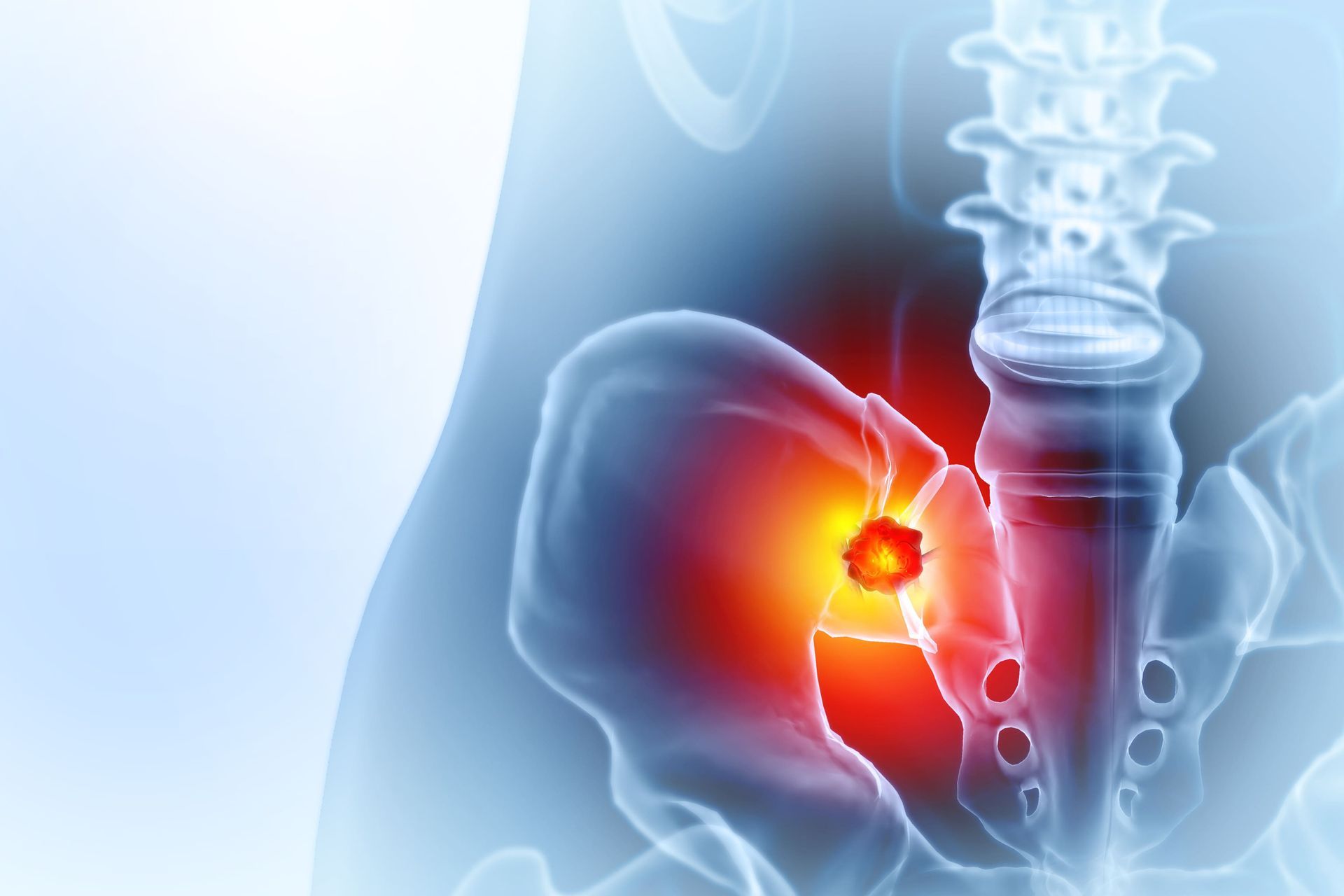 Tumor ósseo maligno tem cura? Entenda as opções de tratamento