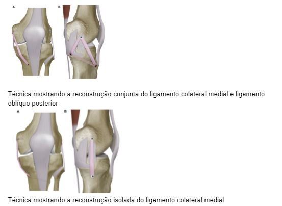 Ligamento Popliteo Obliquo
