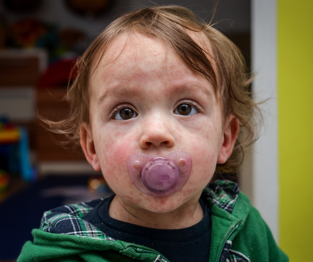 Well Syndrome Canine Acute Eosinophilic Dermatitis With Edema