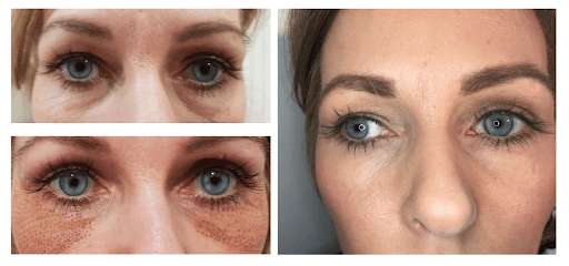 Plexr Plasma Pen resurfaces and tighten tissues.