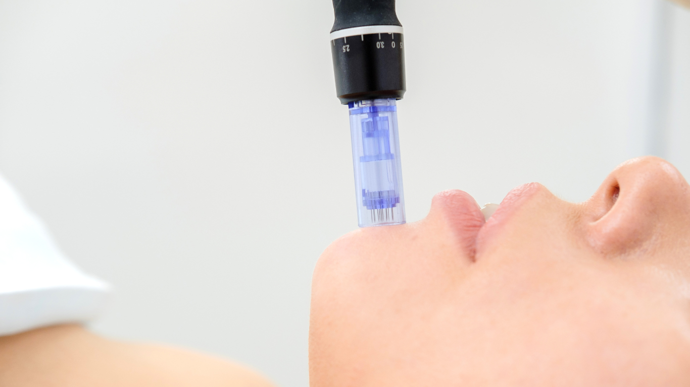 Microneedling | Modern Dermatology of KY and Cosmetic Specialists