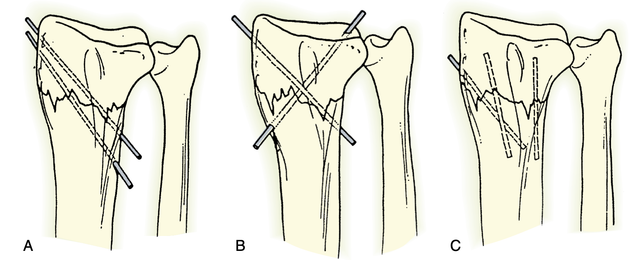 Fratura Do Processo Estiloide Ulnar Treatment Of Symptomatic