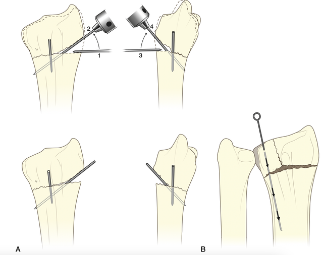 Fratura Do Processo Estiloide Ulnar