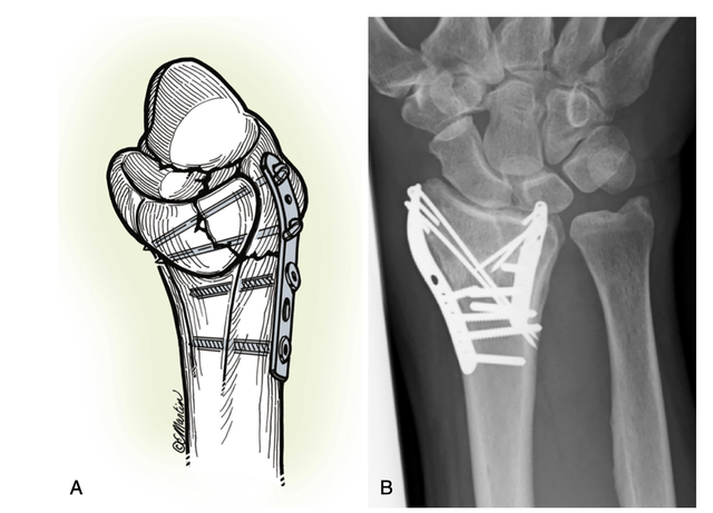Tala Para Fratura Estiloide Ulnar Dor Na Borda Ulnar Do Punho