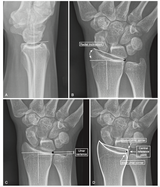Fratura Do Processo Estiloide Ulnar