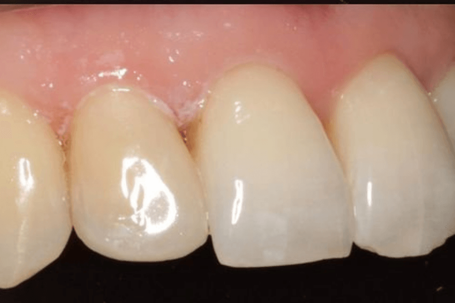 Composite Bonding Cambridge - Same Day Smile Makeover
