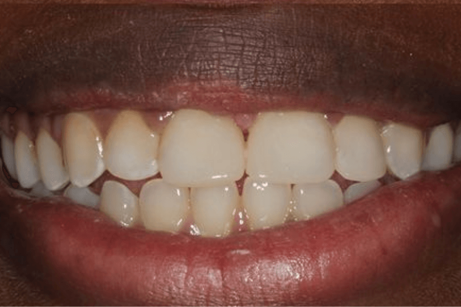 Composite Bonding Cambridge - Same Day Smile Makeover