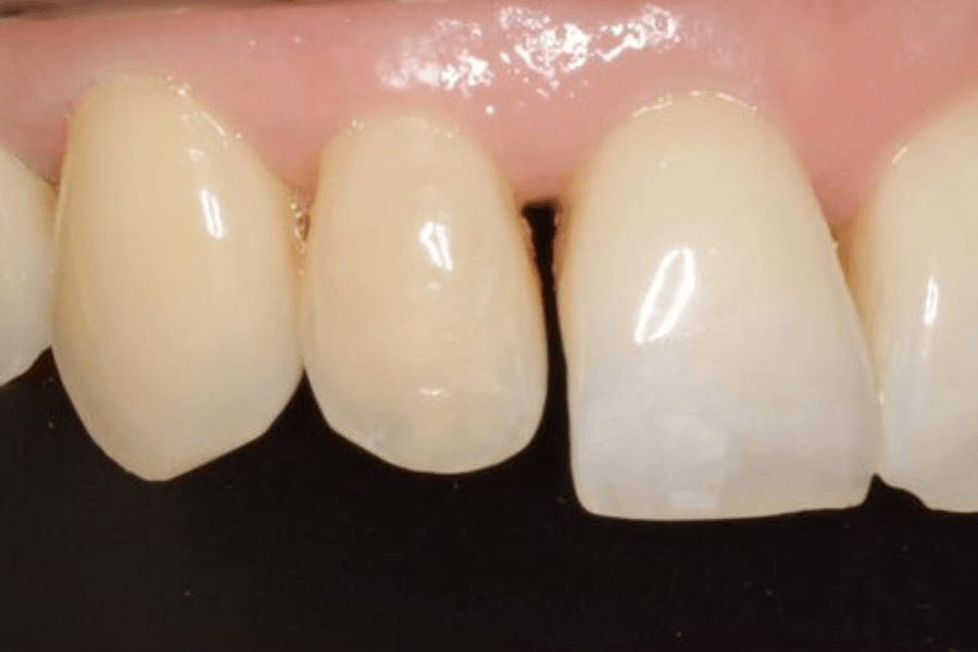 Composite Bonding Cambridge - Same Day Smile Makeover