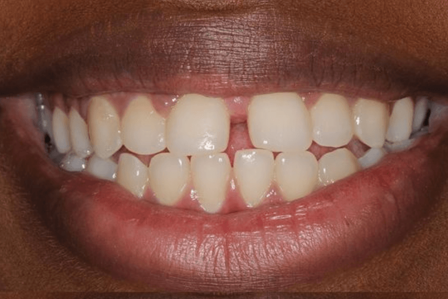 Composite Bonding Cambridge - Same Day Smile Makeover