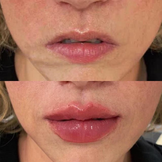 Lip Filler Injections Kent Cost Juvederm Lip Injection