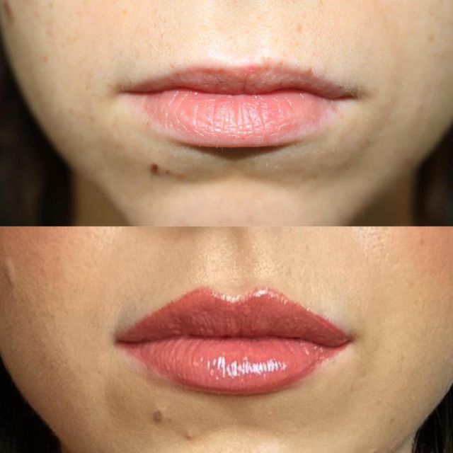 Lip Filler Injections Kent Cost Juvederm Lip Injection