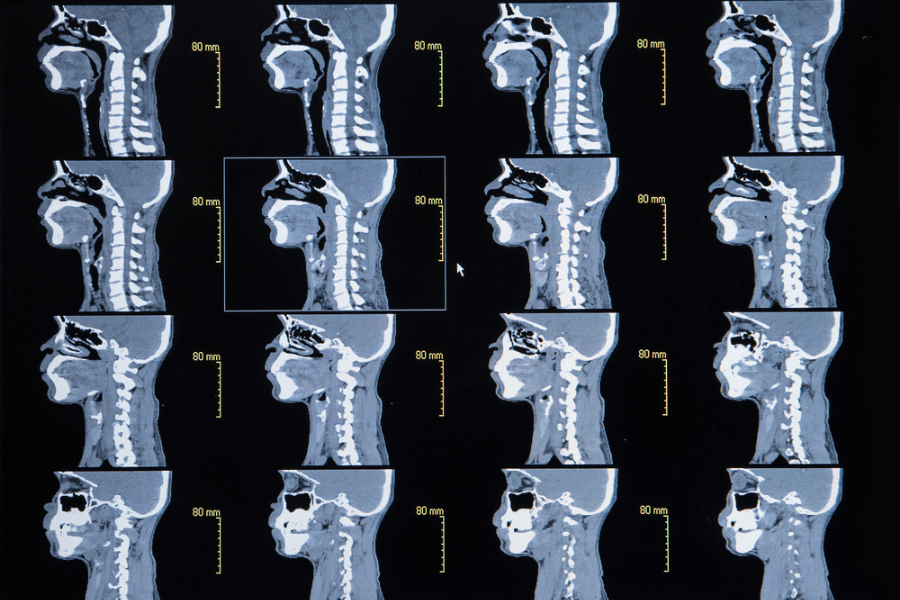 The Center For Sleep Apnea & TMJ — Our Process