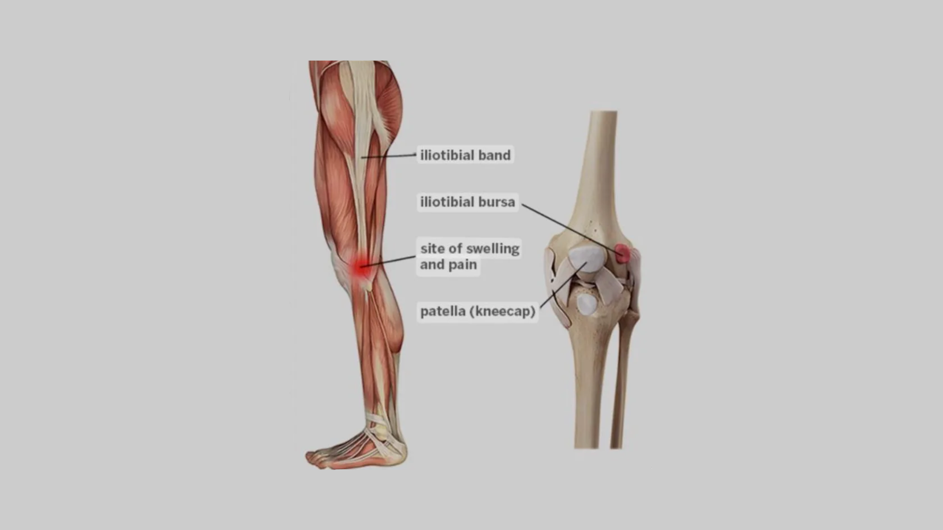 What Does The Latest Research Tell Us About ITB Syndrome?