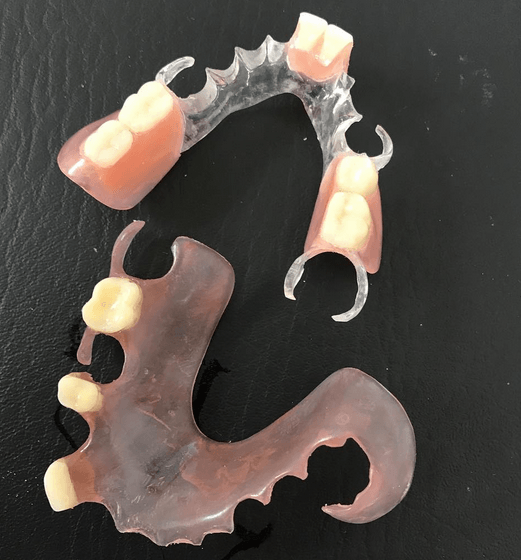 Our Guide to Metal & Acrylic Partial Dentures