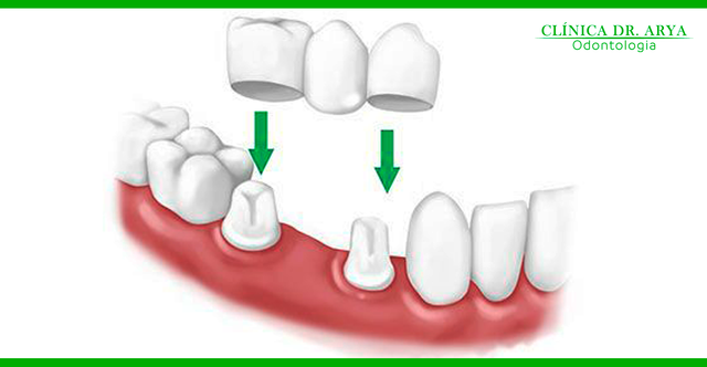 Procedimento De Ponte Dentaria Você Sabia Que Existem Diferentes