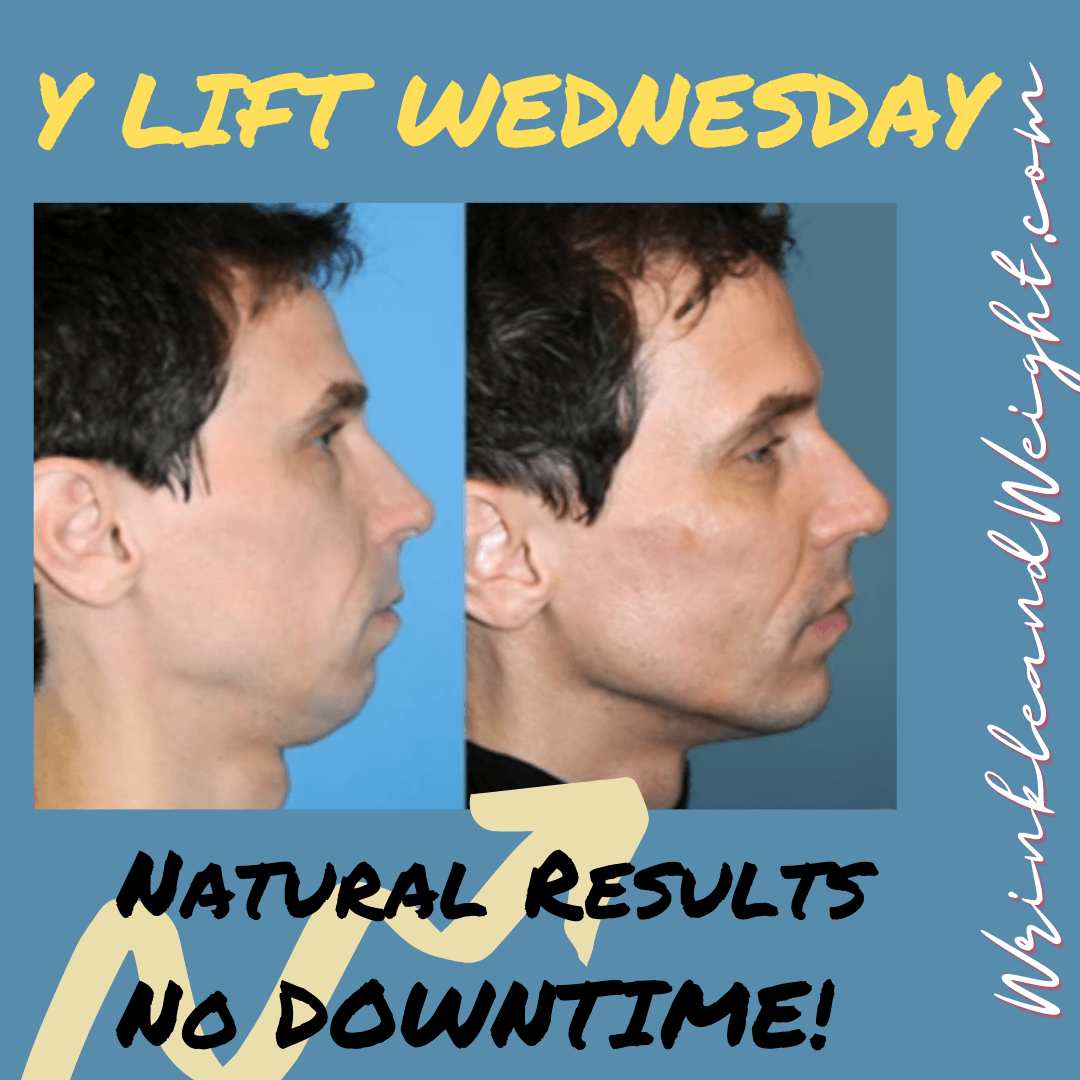 Y-Lift-Liquid Facelift Procedure | Columbus, OH | Dr. Mantor's Wrinkle ...