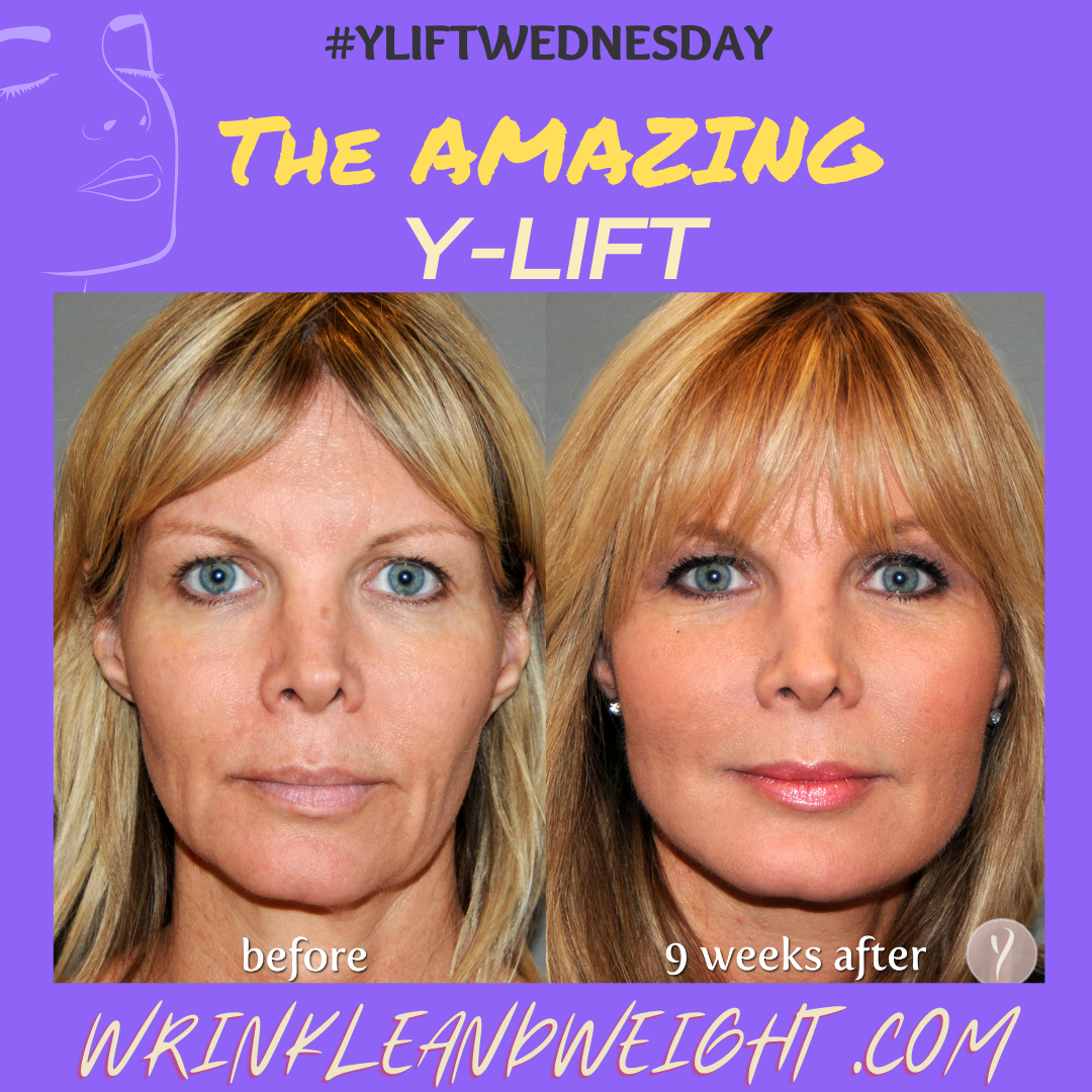 Y-Lift-Liquid Facelift Procedure | Columbus, OH | Dr. Mantor's Wrinkle ...