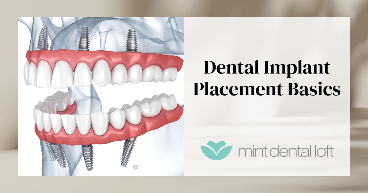 Dental Implant Placement Basics as a Step-by-Step Process