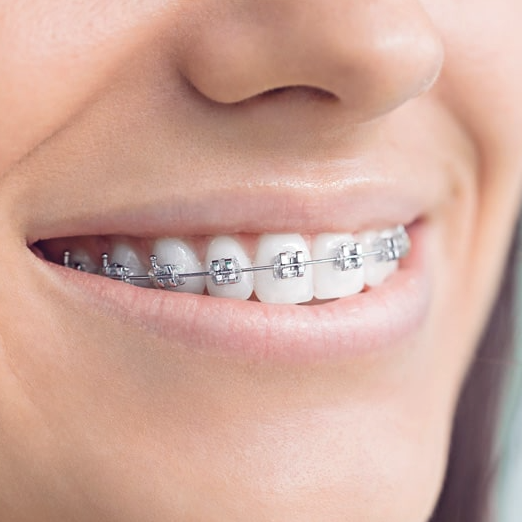 Top braces store