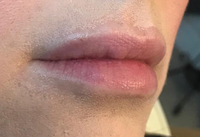 Unexplained Bruising On Lips | Lipstutorial.org