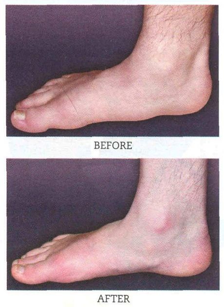 Foot Care Services | Salem, OR | Advanced Foot Clinic