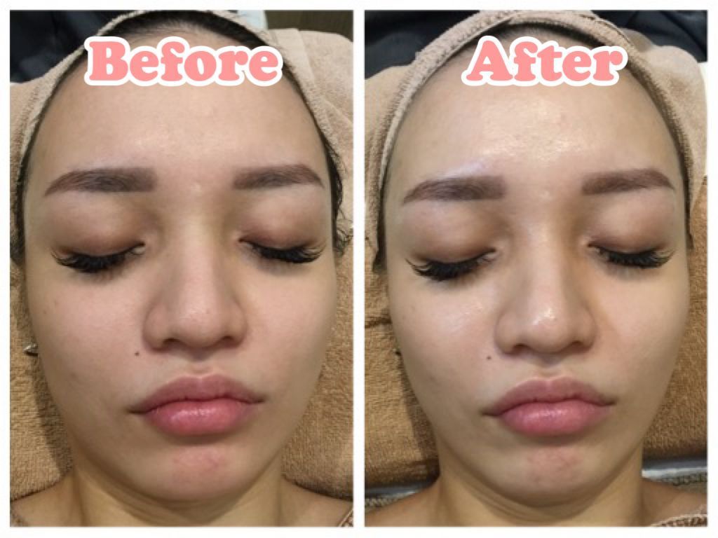 Hydro Glow Facial | Skin Repair